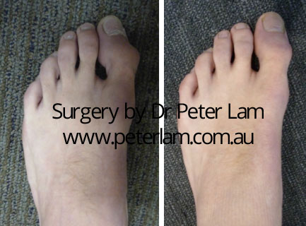 Before & After Toe Deformity Surgery - Sydney Orthopaedic Foot and ...