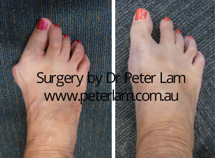 Before & After Toe Deformity Surgery - Sydney Orthopaedic Foot and ...