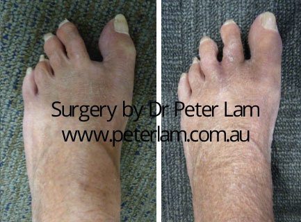 Before & After Toe Deformity Surgery - Sydney Orthopaedic Foot and ...